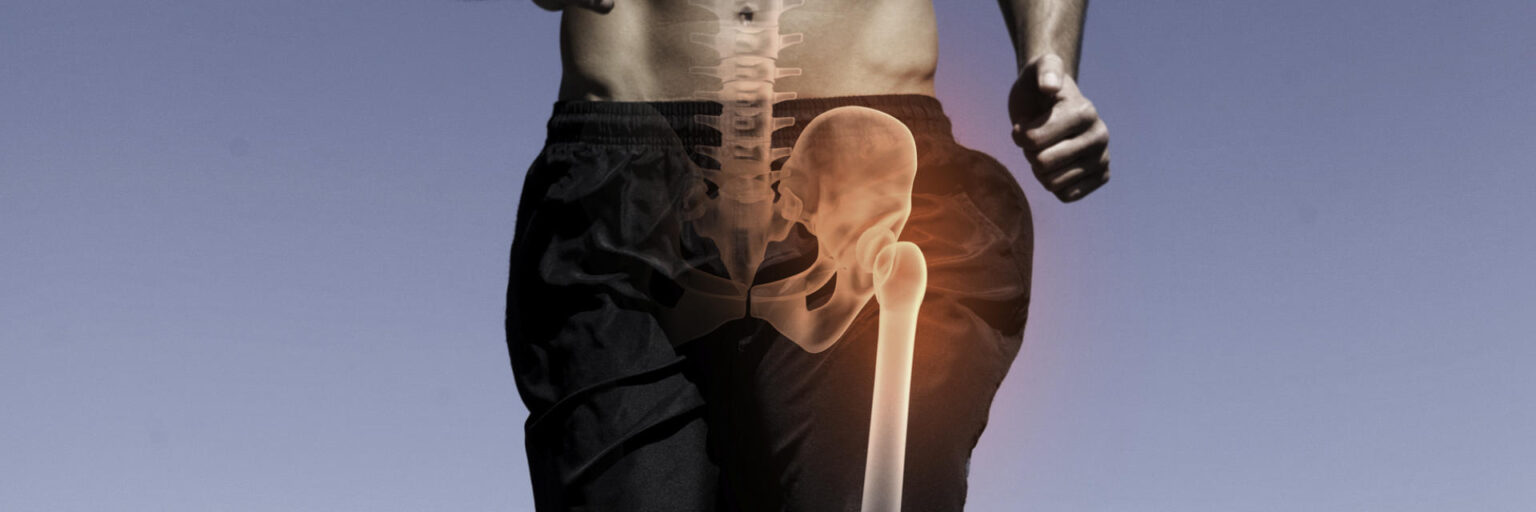 Bikini Incision Direct Anterior Hip Replacement Los Angeles | Dr ...